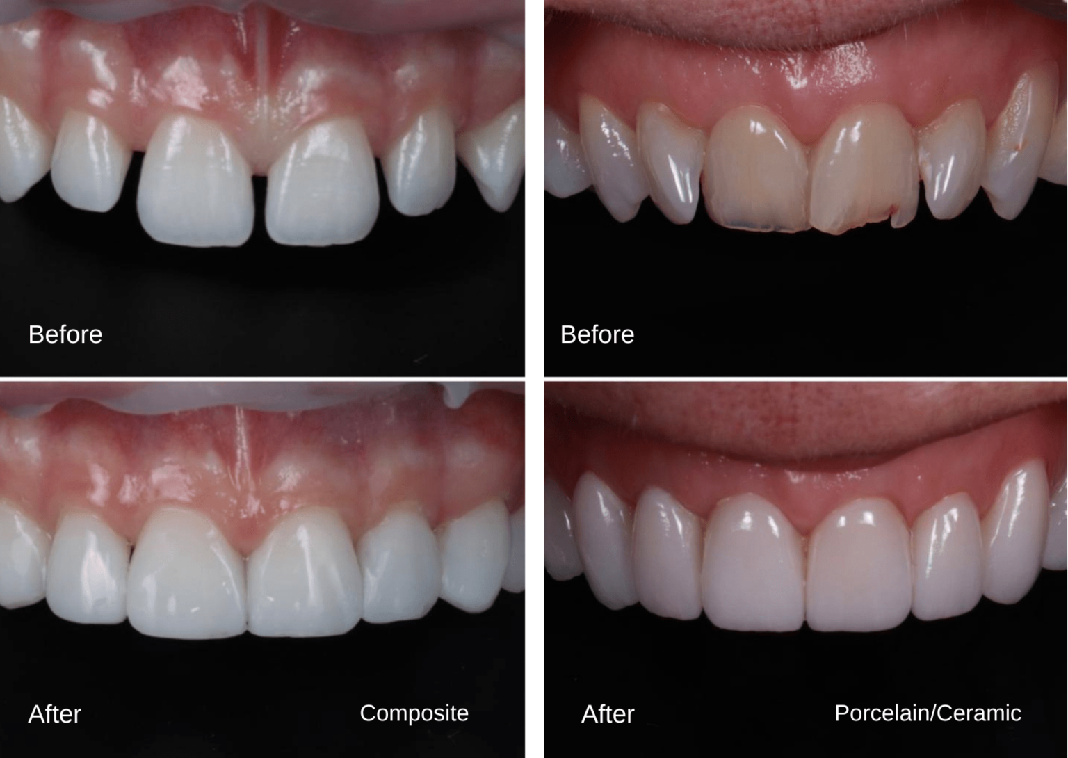 Composite Veneers VS Porcelain Veneers | What Are They?